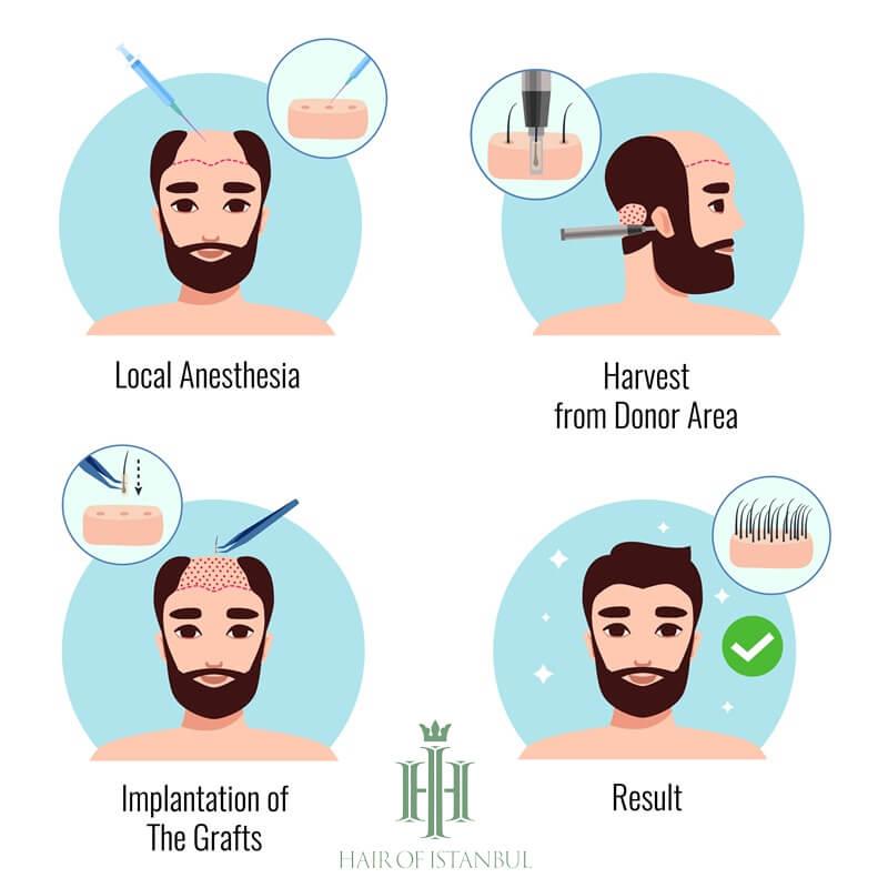 A New Chapter: Steve Carell's Alleged Hair Transplant Revealed! | Hair ... A New Chapter: Steve Carell's Alleged Hair Transplant Revealed! | Hair ...