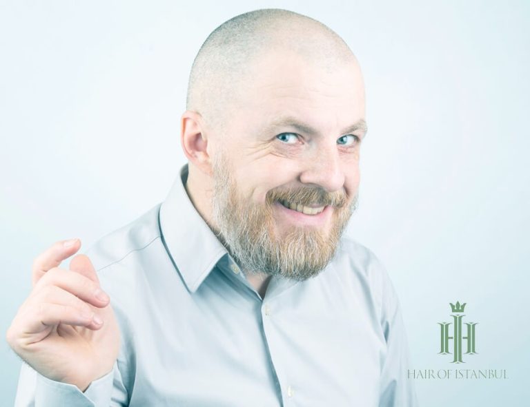 Hair Transplant Success Rate – What to Expect in 2025