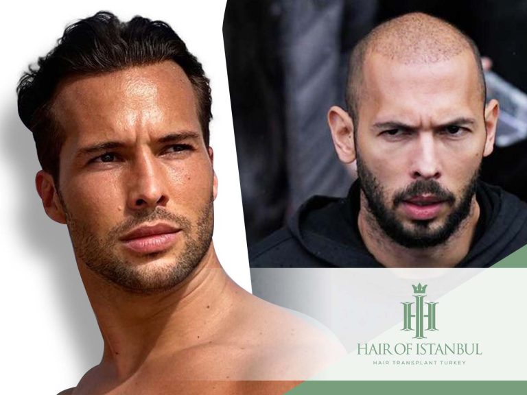 Tristan Tate Hair Transplant: Announcement is Surprising!