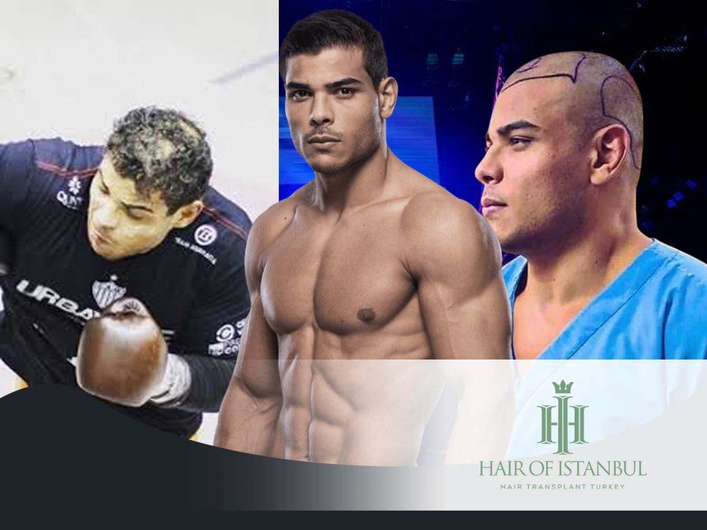 Paulo Costa Hair Transplant: Fighter to Fashion Icon