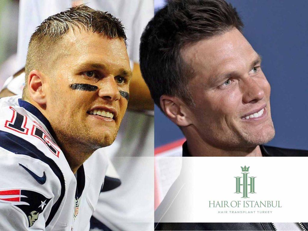 Tom Brady's Rumored Hair Transplant: What's the Story?