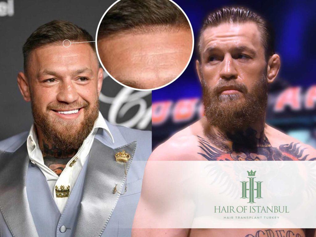Conor McGregor Hair Transplant: Did He Really Get One?
