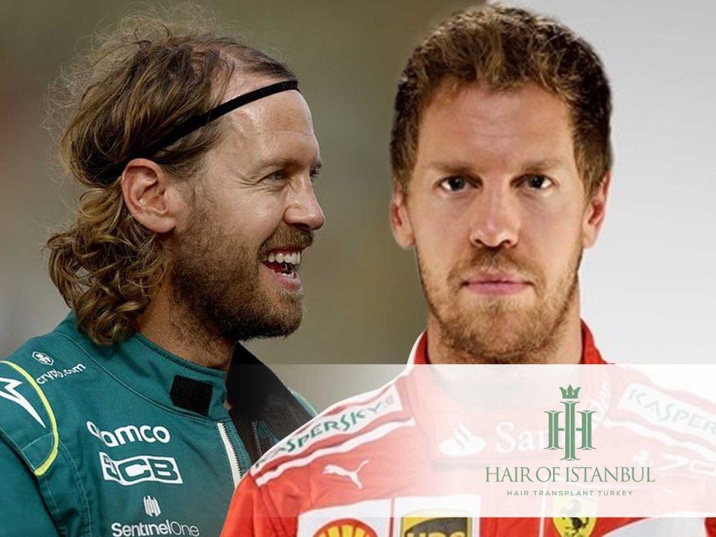 Sebastian Vettel Haartransplantation: Wie sind seine Haare jetzt?