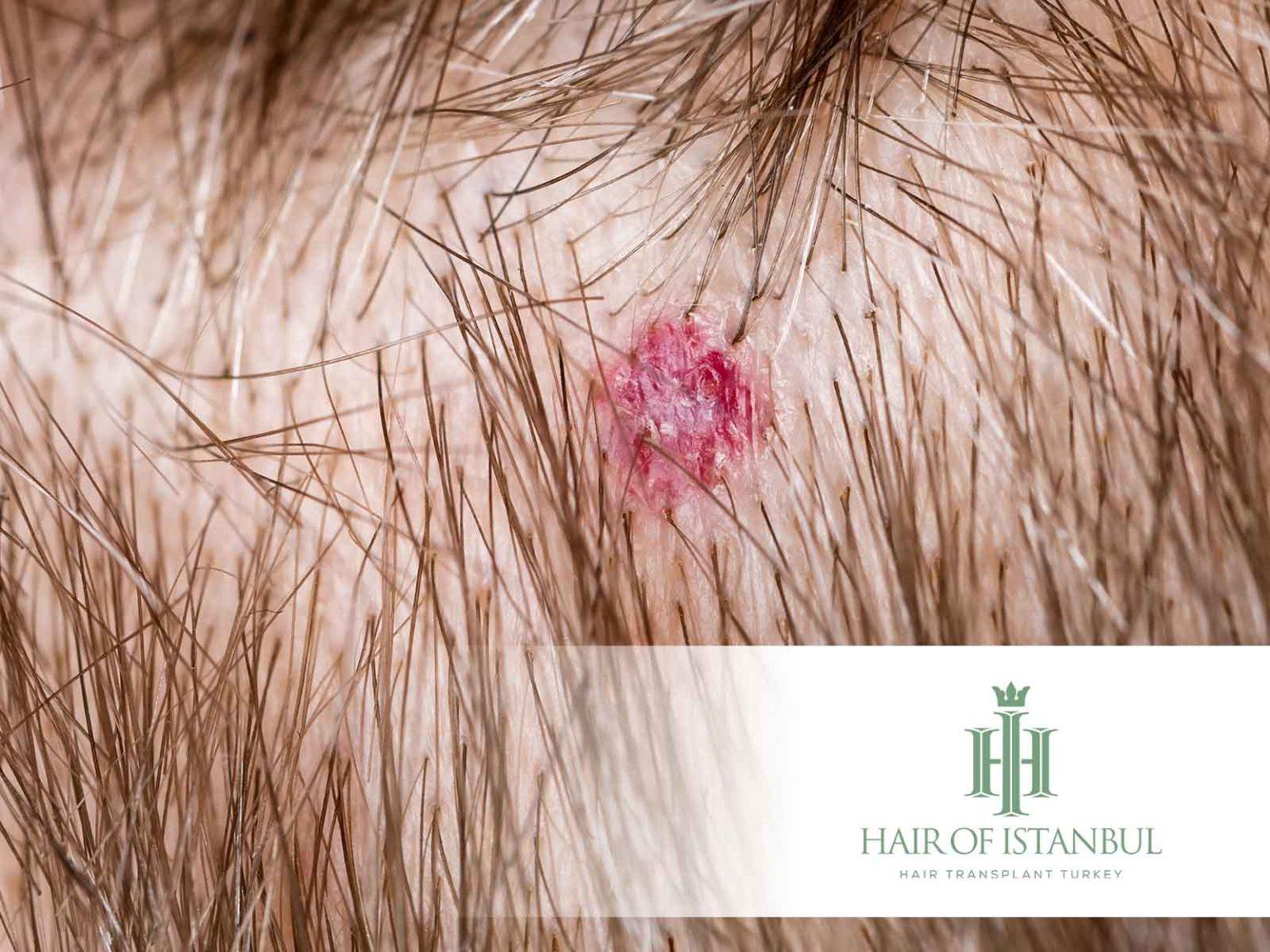 Folliculitis After Hair Transplant: Symptoms and Treatments