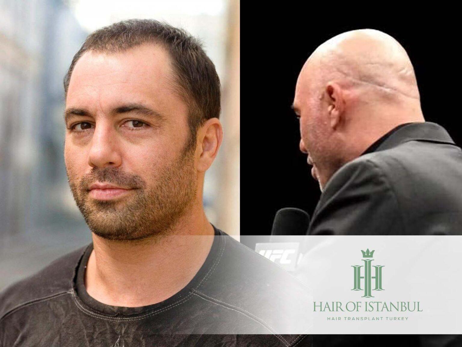 Joe Rogan Hair Transplant: Transformation & Truth Explained