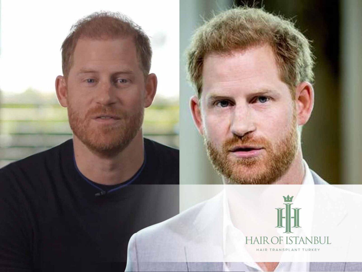 Prince Harry Hair Transplant:Secrets Behind His Thicker Hair