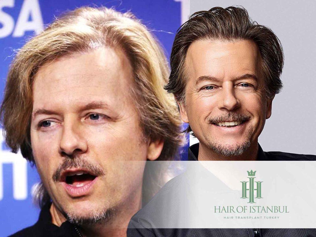 David Spade Hair Transplant: Has He Enhanced His Hairline?