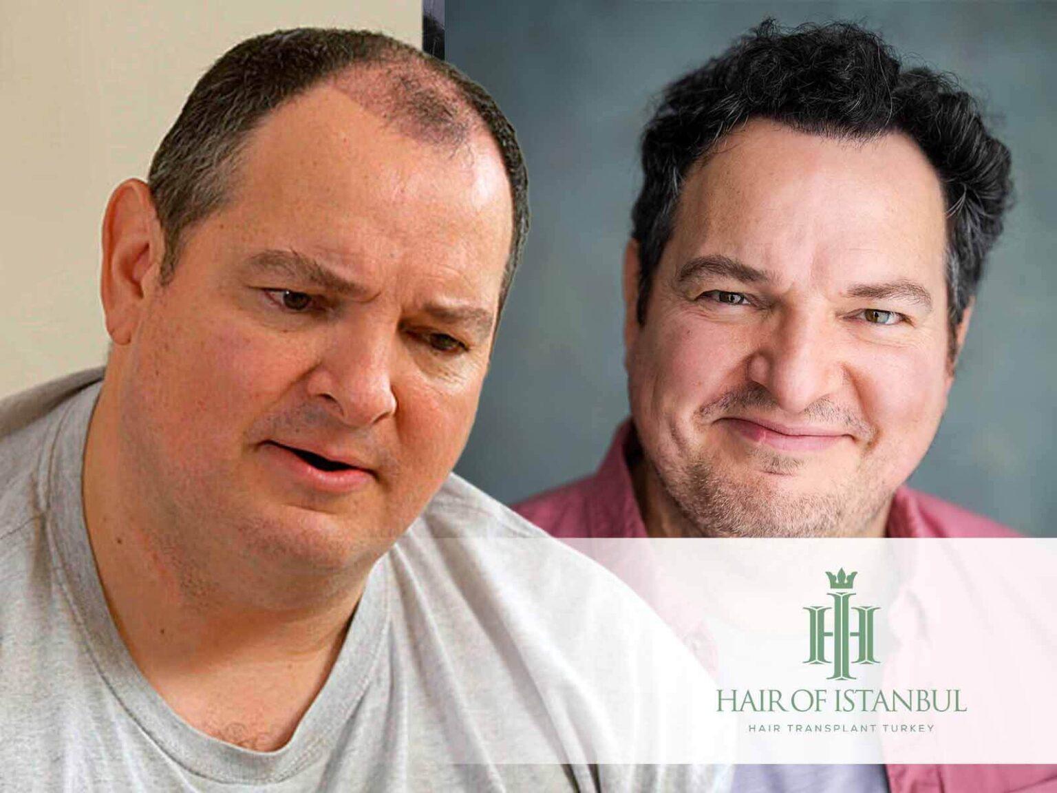 Ian Midlane Hair Transplant A Glimpse into His Refined Look
