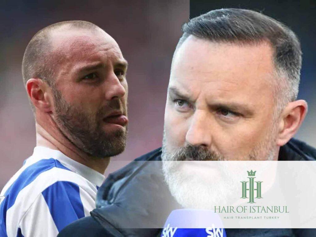 Is a Hair Transplant Permanent? | Hair of Istanbul