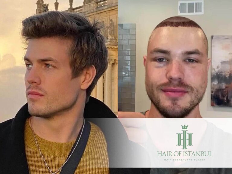 Is Ted Danson Actually Bald? The Enigma of His Hair Revealed