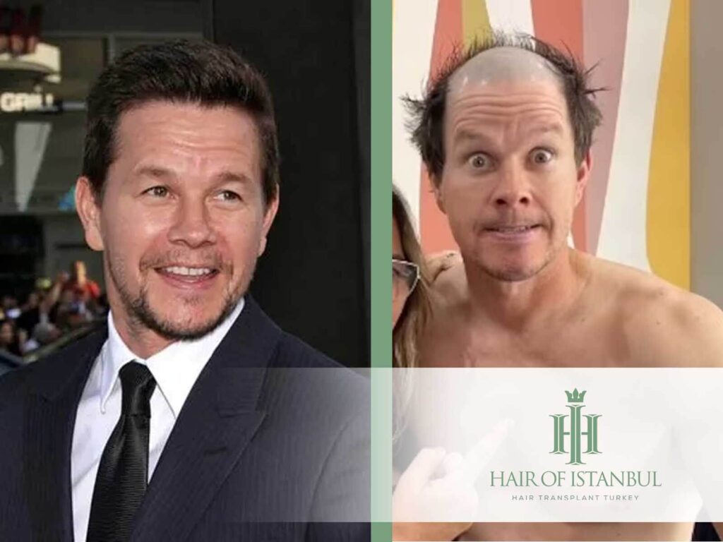 Mark Wahlberg Hair Transplant The Truth Behind His New Look