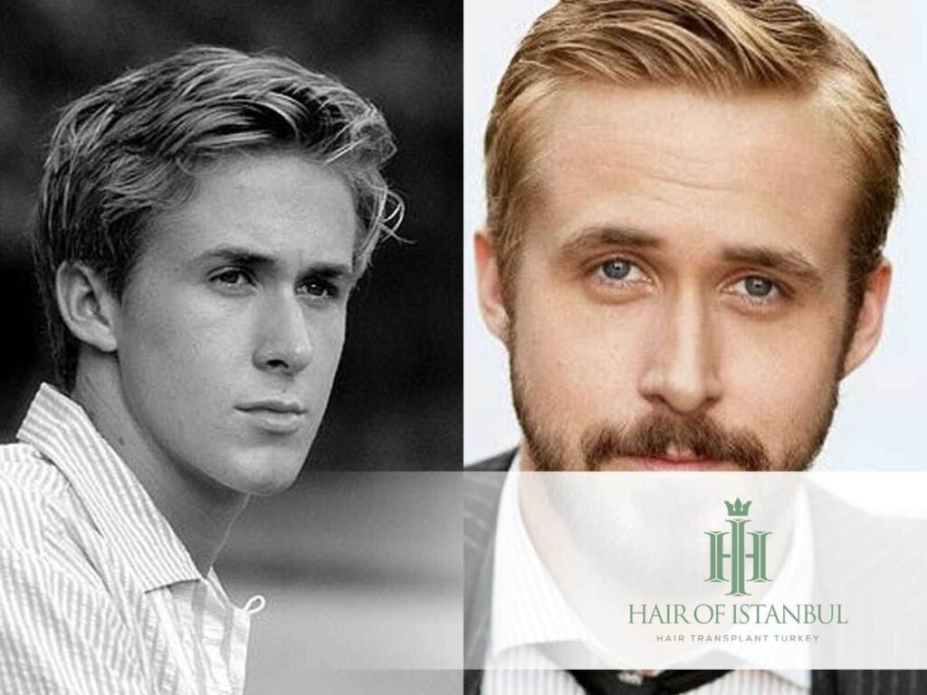 Ryan Gosling Receding Hairline:Did He Get a Hair Transplant?