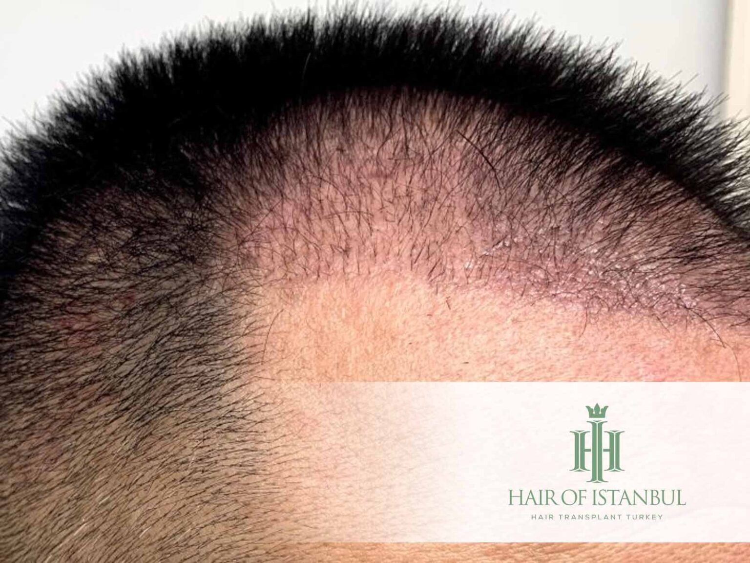 What is the Ugly Duckling Phase of Hair Transplant?