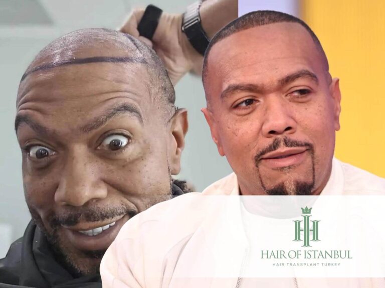 Axar Patel Hair Transplant: A Closer Look at His Striking Change