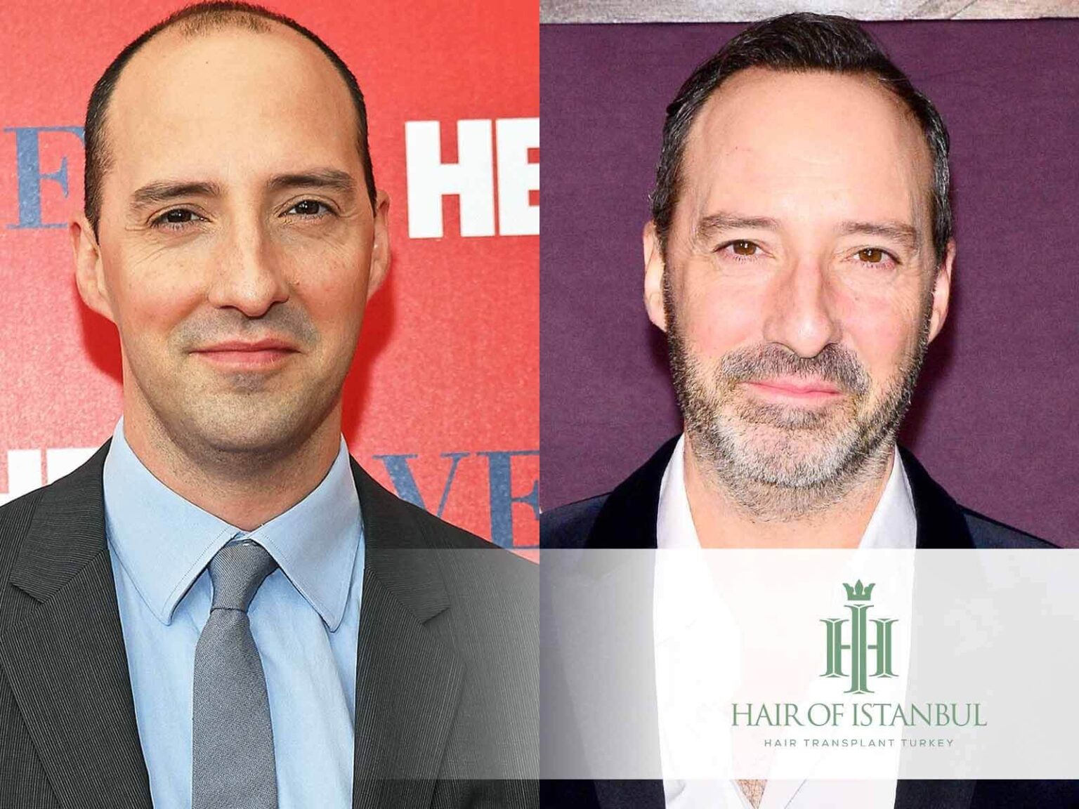 Is Ted Danson Actually Bald? The Enigma of His Hair Revealed