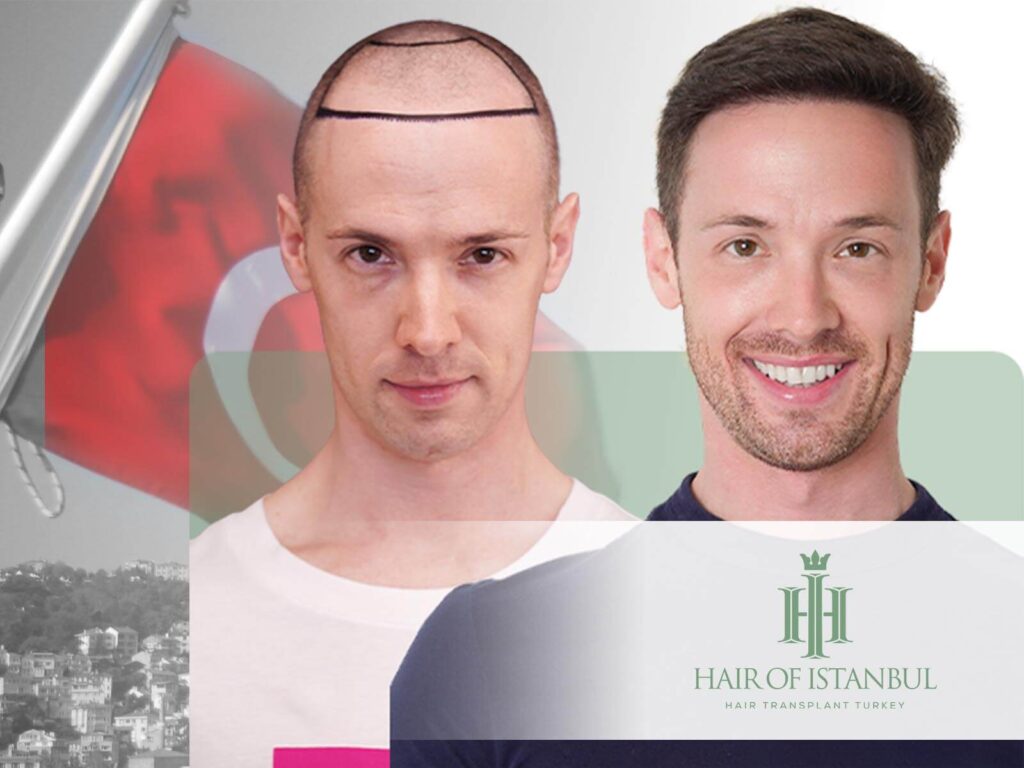 Turkey Hair Transplant Results: See the Stunning Transformations