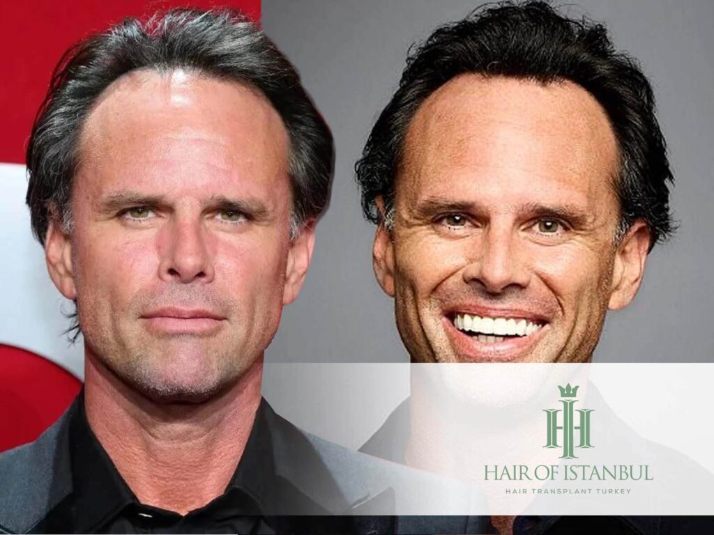 Axar Patel Hair Transplant: A Closer Look at His Striking Change