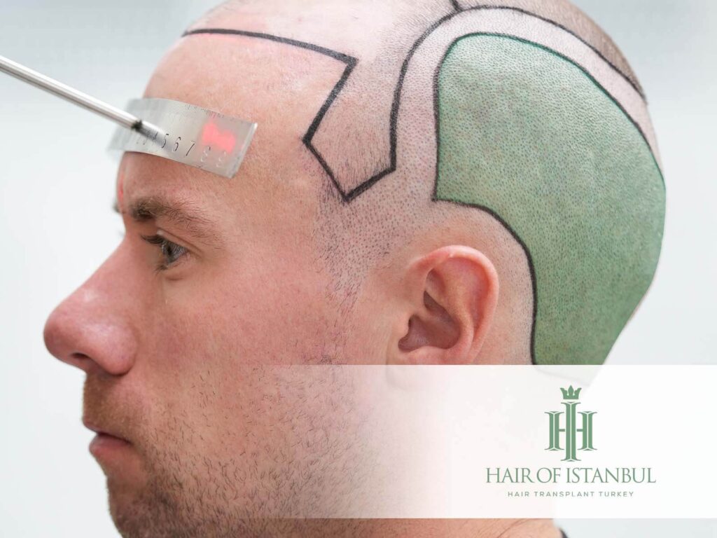 Is Ted Danson Actually Bald? The Enigma of His Hair Revealed